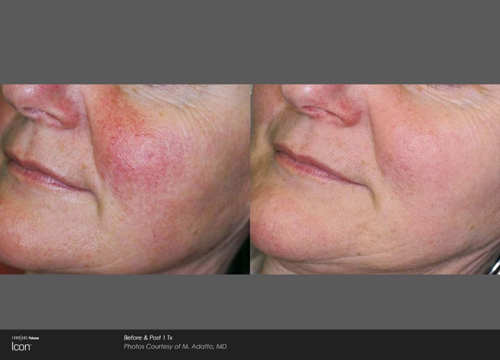 IPL Photo Rejuvenation | Redondo Beach, CA | Abbracci Med Spa